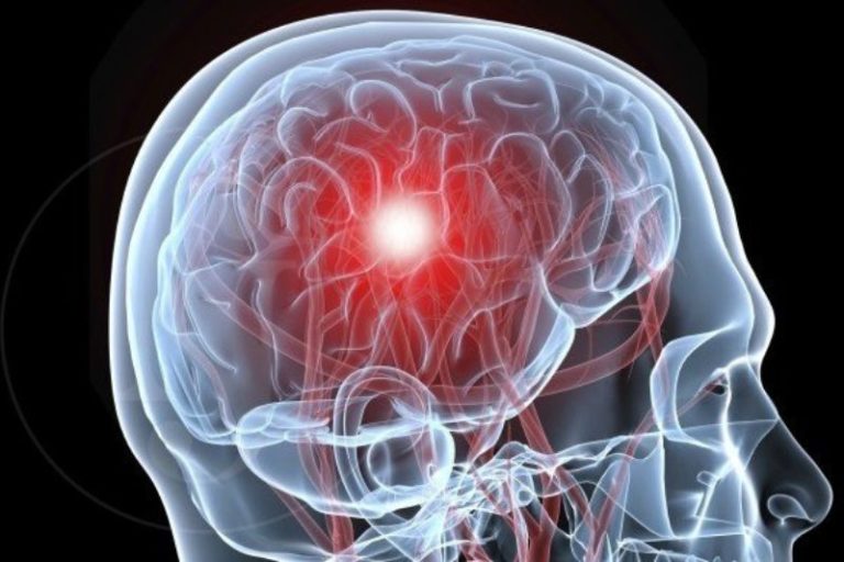 Tratamiento del ictus abordado desde la fisioterapia | Neuraces