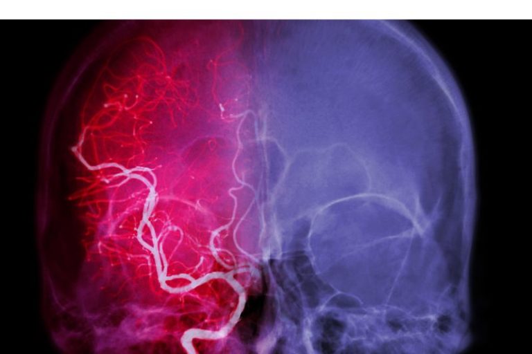 Anoxia Cerebral | Neuraces